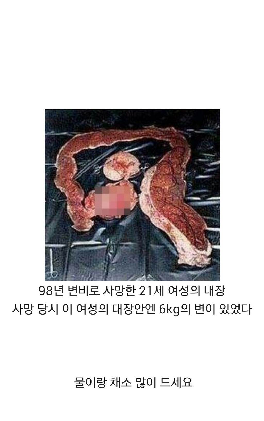 변비로 죽은 여성의 내장 - 인스티즈(instiz) 이슈 카테고리